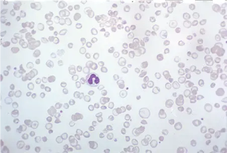 Case study (34) –( Hypochromic microcytic anemia)- Iron deficiency anemia