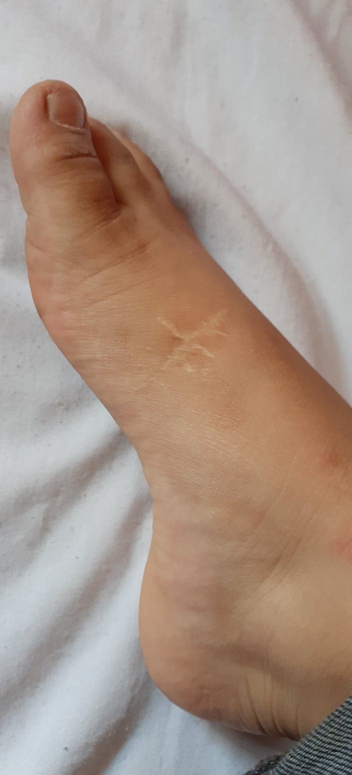 The story of how I got a scar on my right foot.