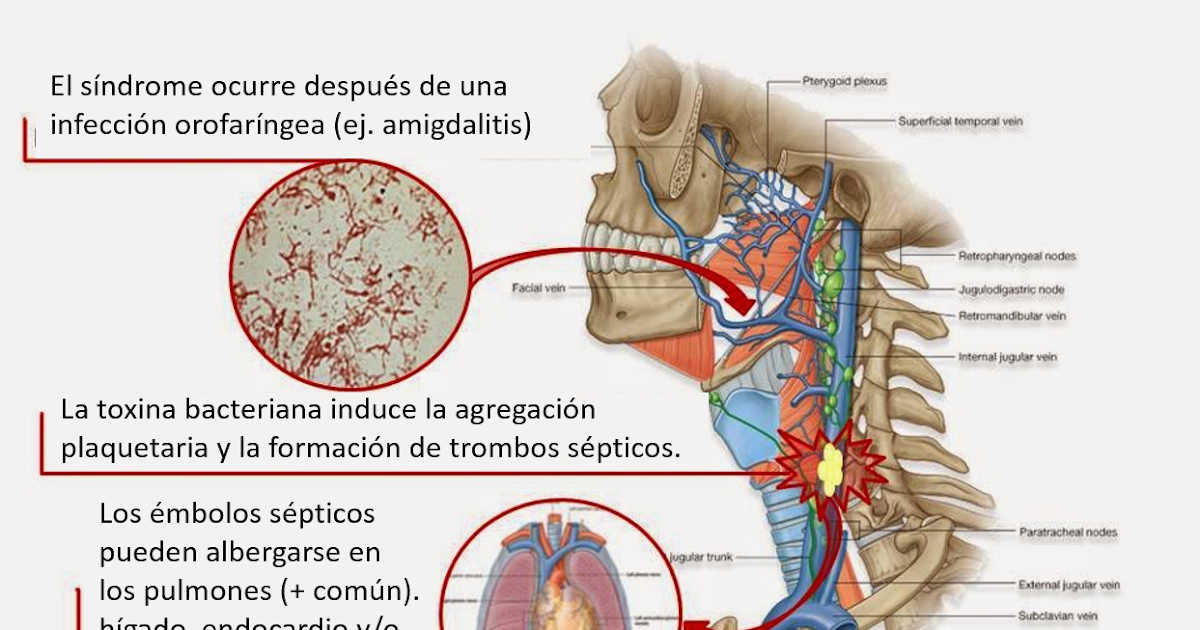 A P U N T E S DE M E D I C I N A: SÍNDROME DE LEMIERRE