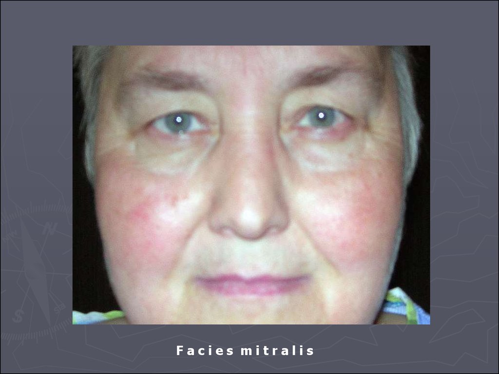 Facies Mitralis Skin Health: What It's Trying To Tell You About