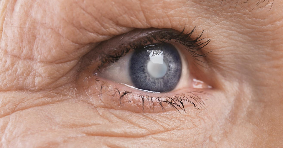 Cirugía De Glaucoma En México El Mejor Hospital De OftalmologÍa