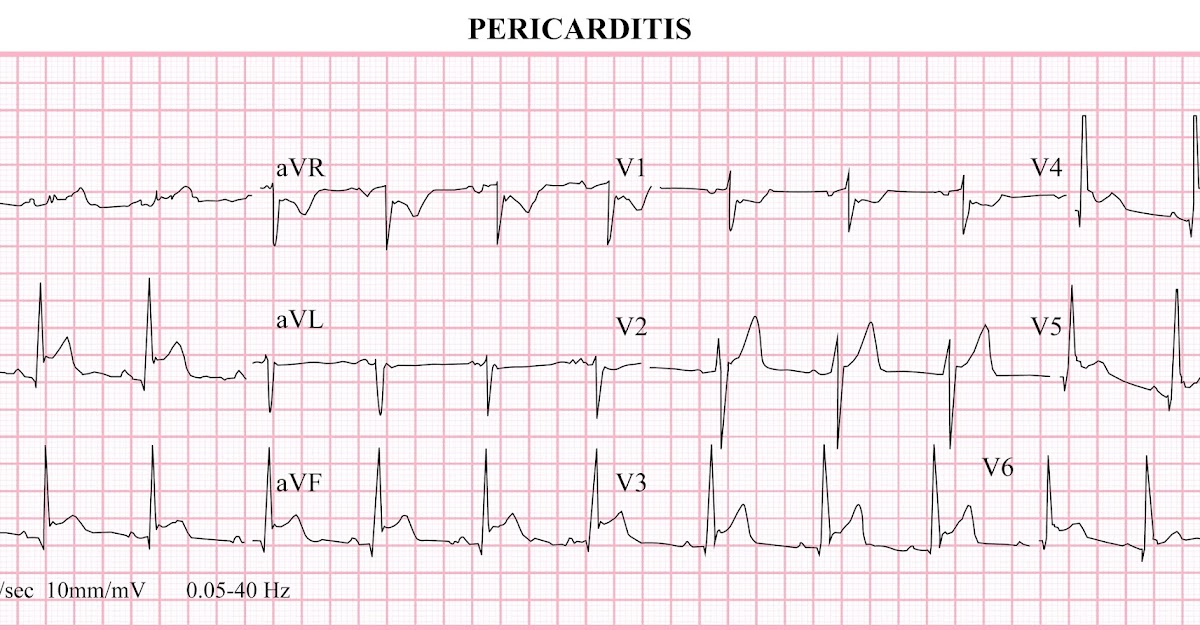 ECG Educator Blog : Pericarditis
