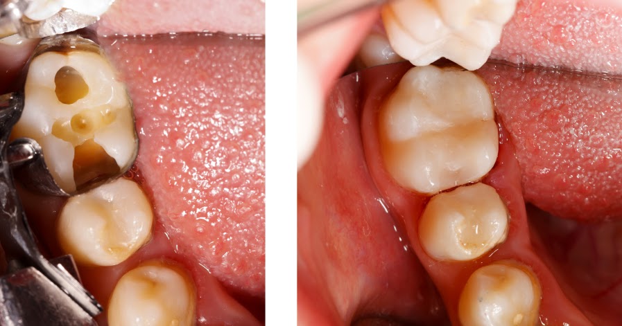 How to Reverse Cavities Naturally - Health Queen