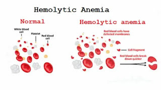 Hemolytic anemias (HAs)