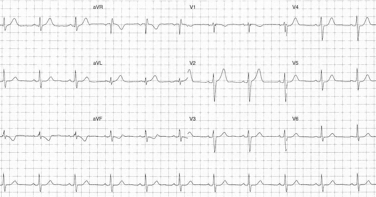ECG of the Week: ECG of the Week - 11th July 2016 - Interpretation