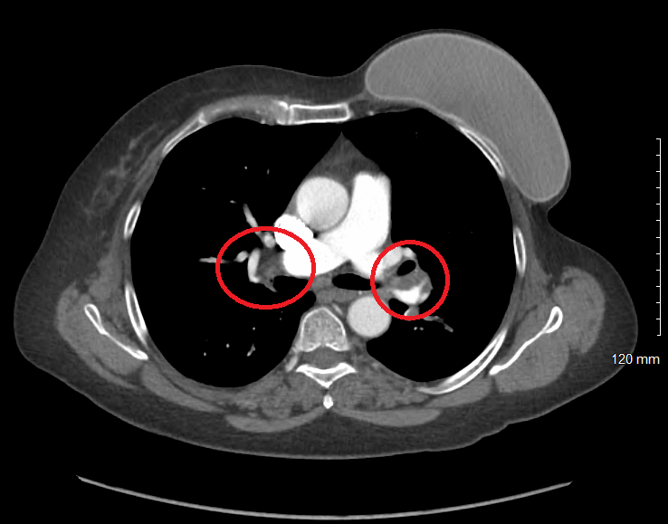 Chronicles Of My Residency: "That is a huge PE!!" Massive versus ...