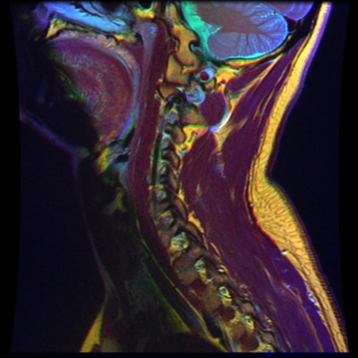 Nevit's blog: Color MRI of Cervical vertebrae