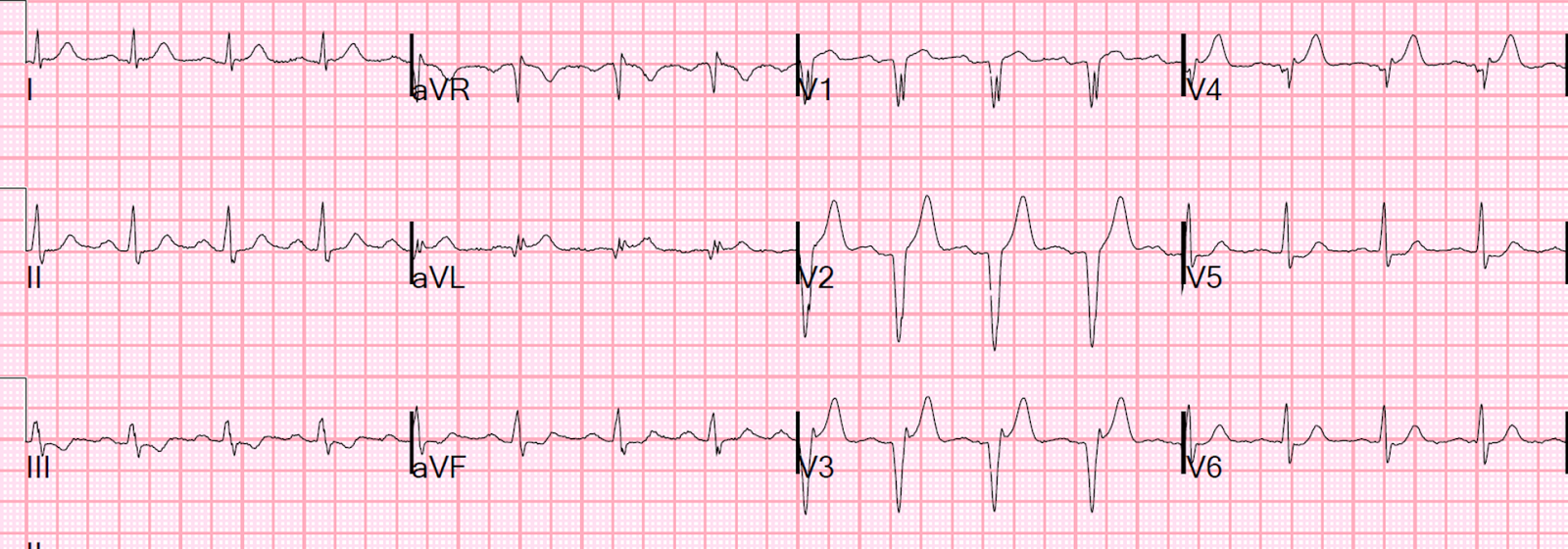 Dr. Smith's ECG Blog: Subtle Anterior STEMI Superimposed on Anterior LV ...