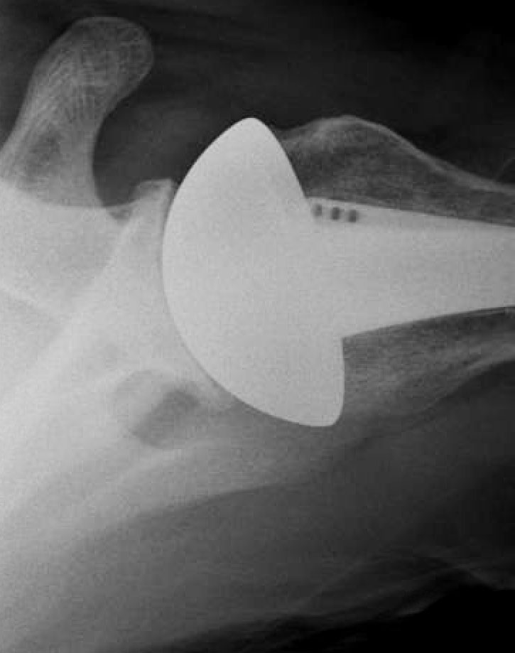 UW Shoulder and Elbow Academy: B2 genoid in a young active meam