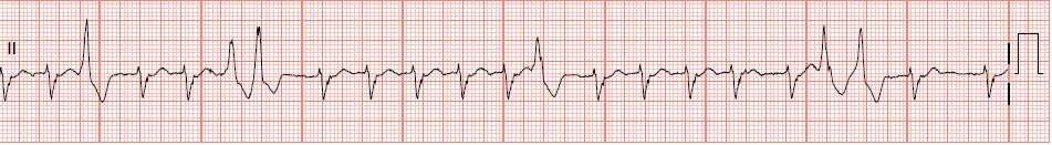 Float Nurse: EKG Rhythm Strips 20: Ventricular Ectopy 3