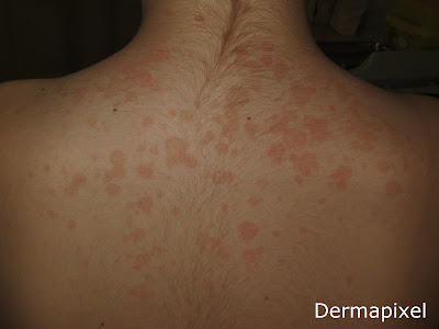 Dermapixel: Manchas que no pican