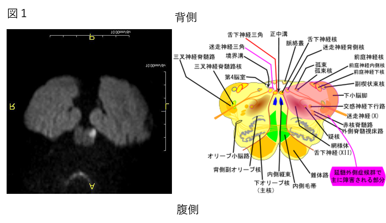 脳卒中後のLateropulsion：その理解と治療戦略 - Study channel