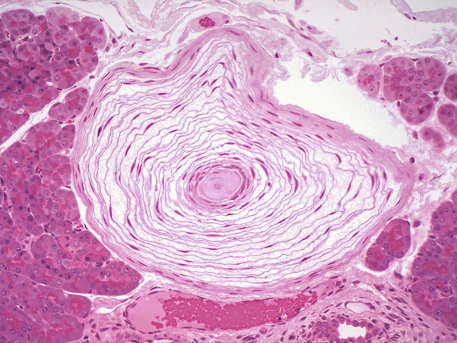 Medical Terms & Сlinical Сases : Pacini's corpuscles