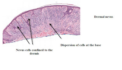 Dermpath Made Simple - Neoplastic: Benign Nevi