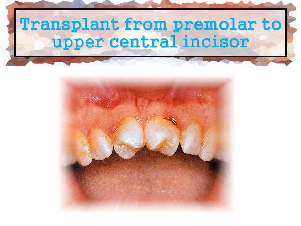 Dentistry: Tooth Transplantation