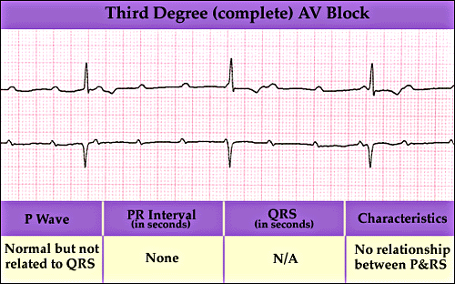 3rd Degree AV Block | INA - ECG