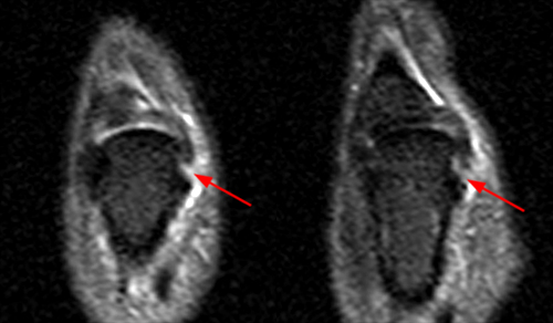 MRI Musculo-Skeletal Section: Ulnar collateral ligament.