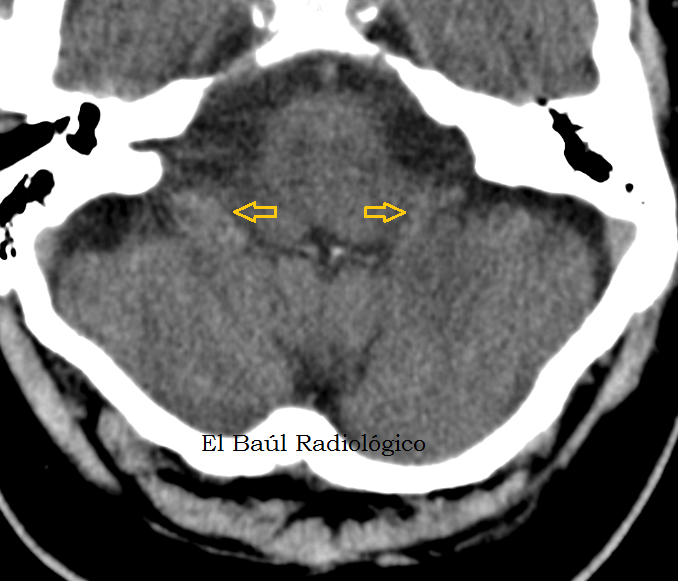 El Baúl Radiológico: LÓBULO FLOCULONODULAR CEREBELOSO. (The Cerebellar ...