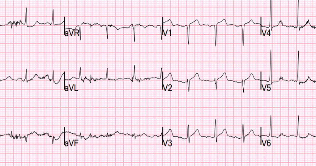 Dr. Smith's ECG Blog: Septal STEMI with lateral ST depression, then has ...