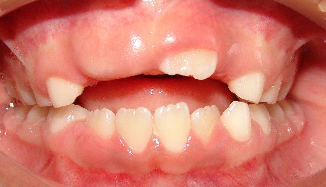 Ortodoncia en El Salvador: Dientes Supernumerarios en denticiòn mixta ...