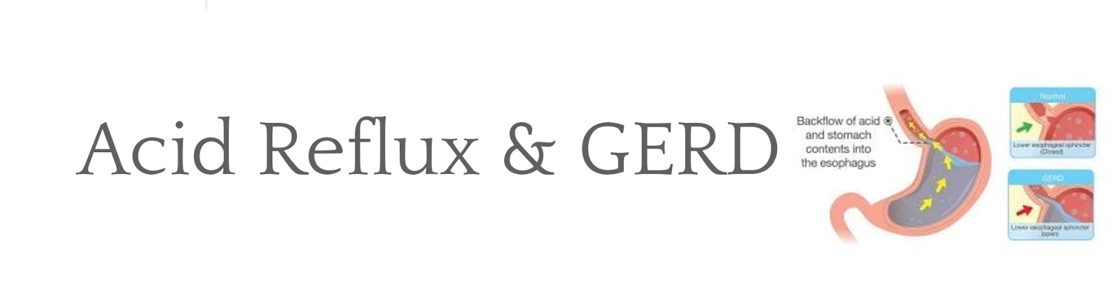 Heartburn vs. Acid Reflux vs. GERD | AcidRefluxStrategy365