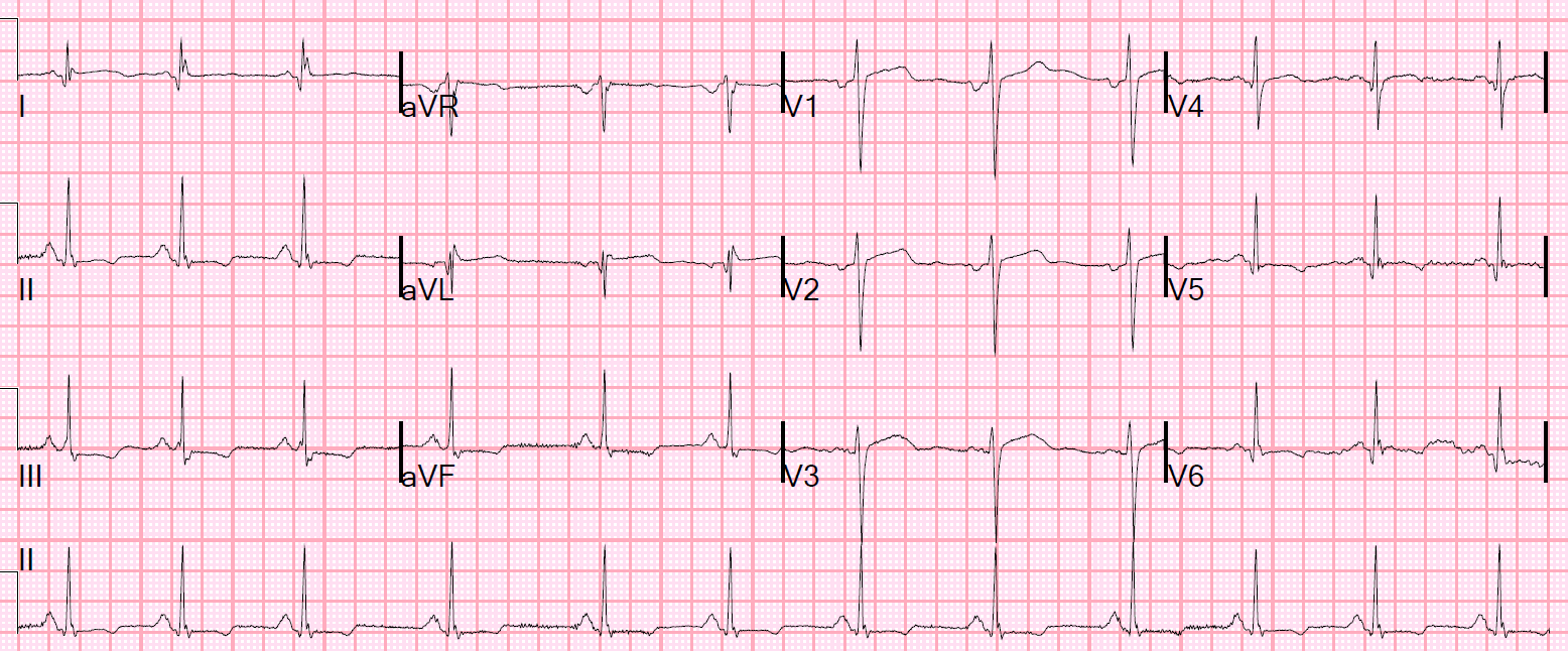 Dr. Smith's ECG Blog: Dyspnea and Convex ST elevation, Marked LVH, with ...