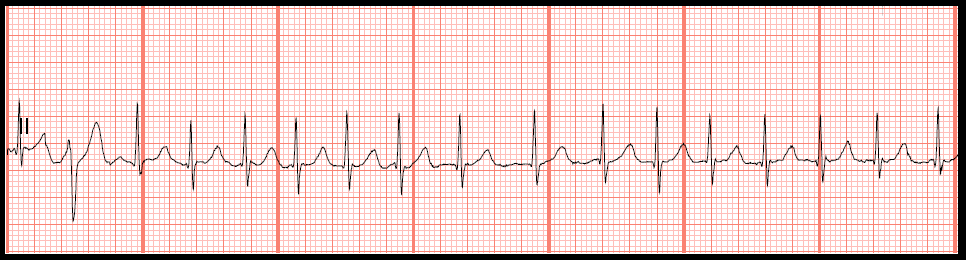 Practice EKG Strips