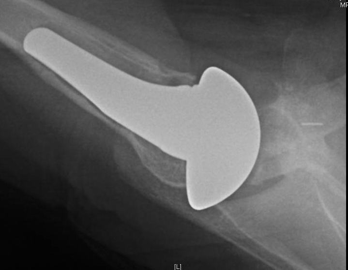UW Shoulder and Elbow Academy: Revising a loose short stem humeral ...