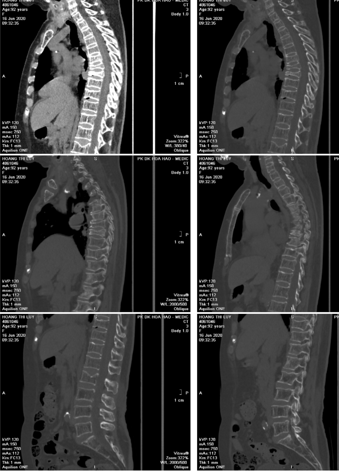 VIETNAMESE MEDIC ULTRASOUND: CASE 587 : POCUS for A CASE of CHEST PAIN ...