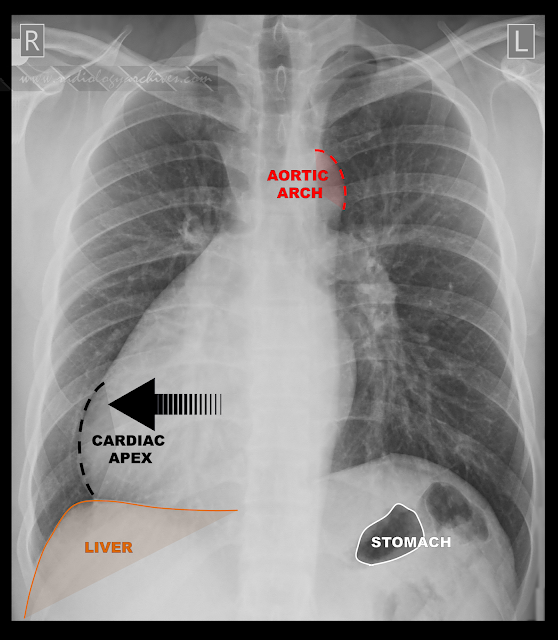 Radiology Archives: Δεξιοκαρδία (Situs Solitus & Δεξιοκαρδία με ...