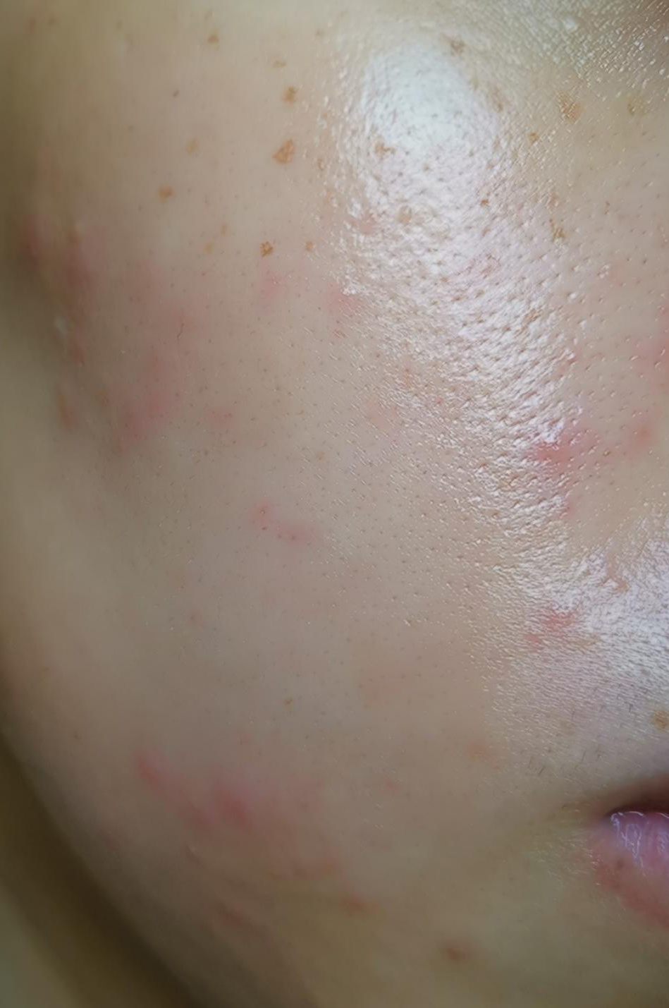 Live life to the fullest!: Active acne bumps after microneedling facial ...