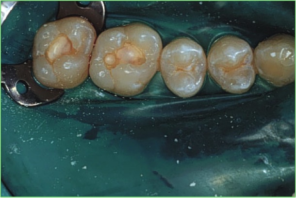 DrChetDMD: Cavities Restored with Amalgam