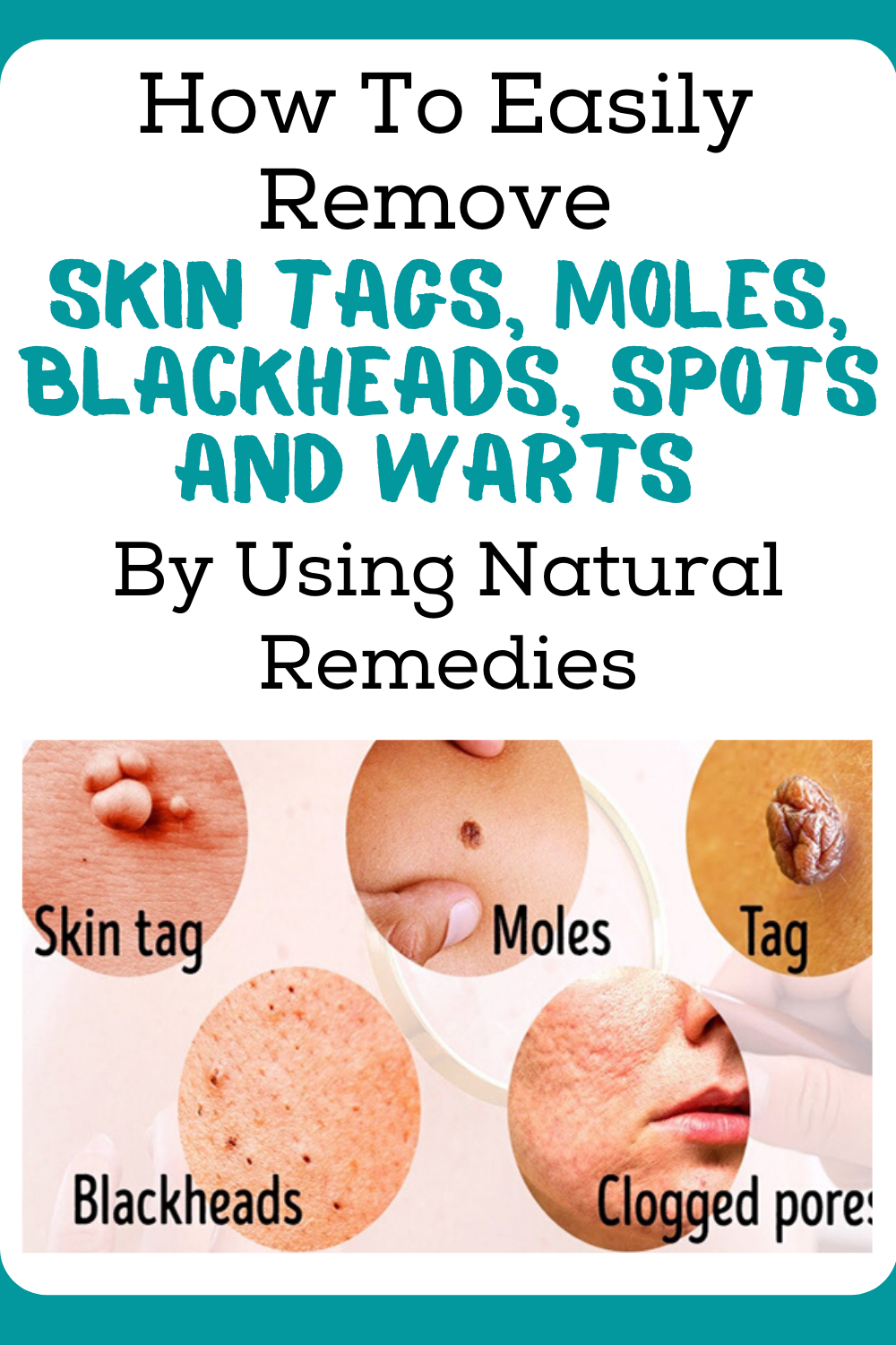 How To Easily Remove Skin Tags Moles Blackheads Spots And Warts By how-to-easily-remove-skin-tags-moles-blackheads-spots-and-warts-by