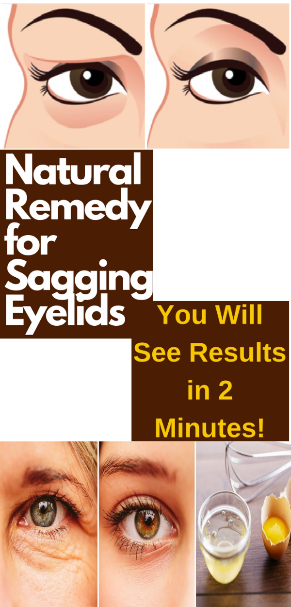 Natural Remedy for Sagging Eyelids – You Will See Results in 2 Minutes ...