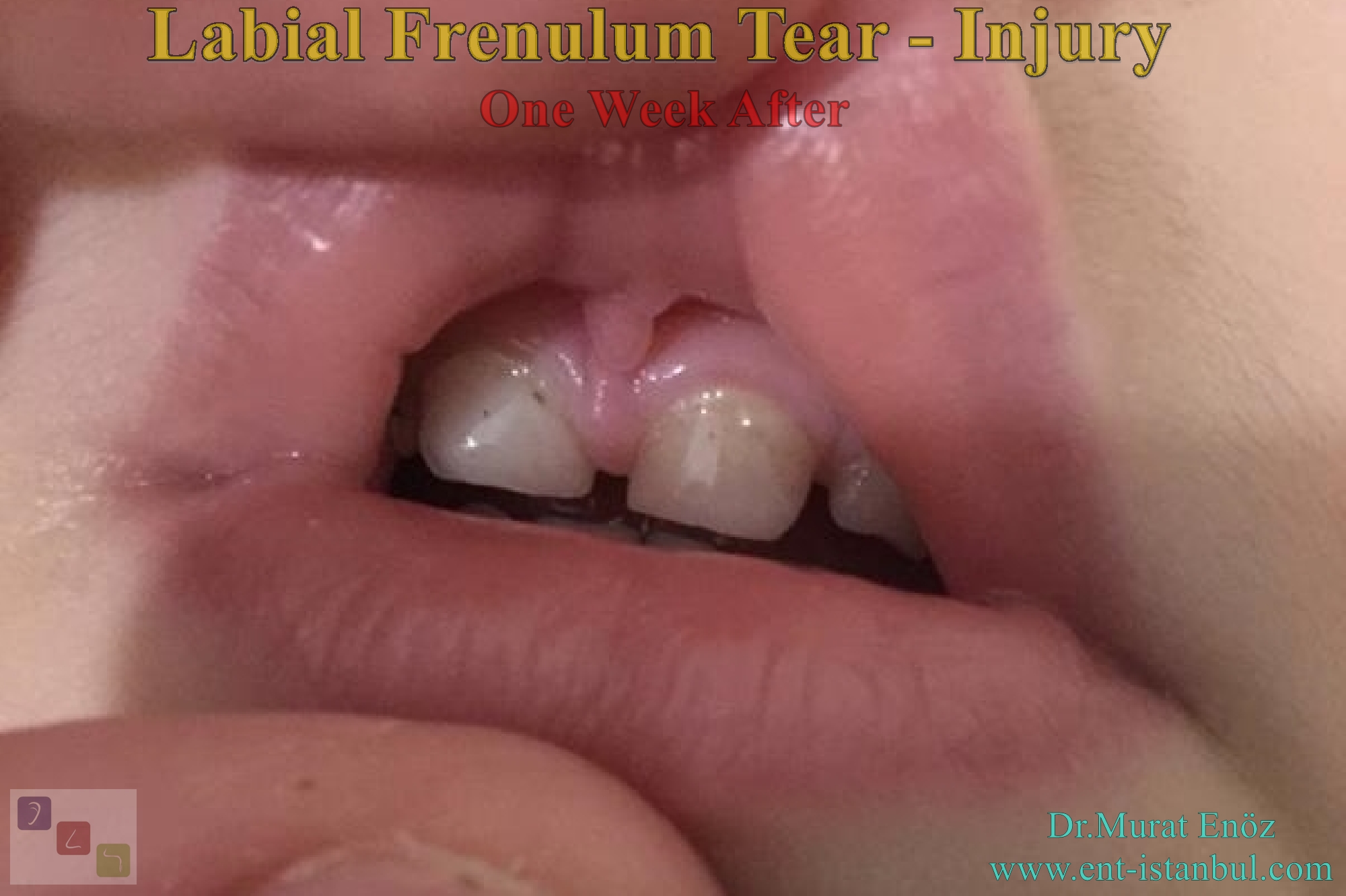 Torn Labial Frenum