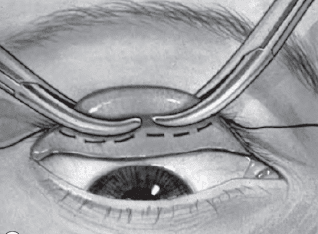 What is Involutional ectropion