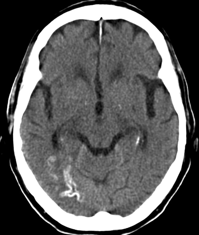 Dr Balaji Anvekar FRCR: Cortical Laminar Necrosis