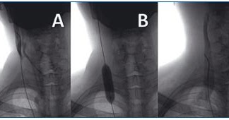 CCSVI ja MS-tauti: VIIDEN SUOMALAISEN MS-POTILAAN KOKEMUKSET LASKIMO ...