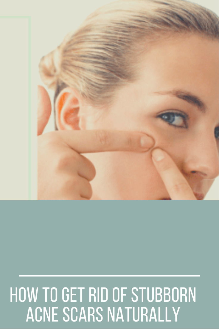 How To Get Rid Of Stubborn Acne Scars Naturally
