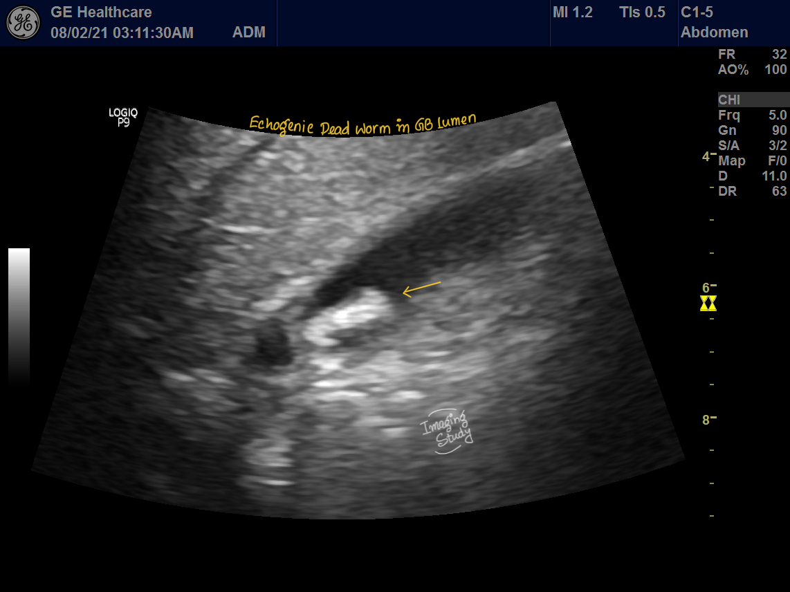 Case 31: Worm in Gallbladder - Biliary Ascariasis ~ Imaging Study