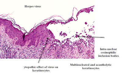 Dermatopathology Made Simple - Inflammatory: Vesicles or Blisters
