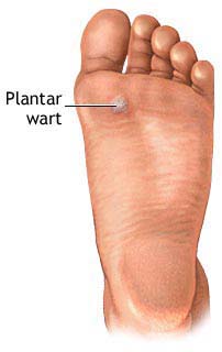 Plantar Wart Removal: 3 ways of plantar wart treatment