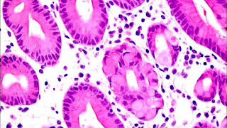 Signet ring cell carcinoma