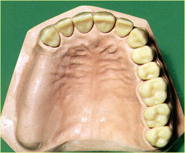 Clasificación de kennedy