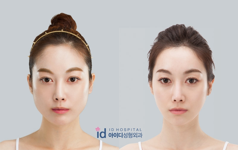 ID Hospital Korea: [ID Hospital In The News] The Secret to an Ideal V ...