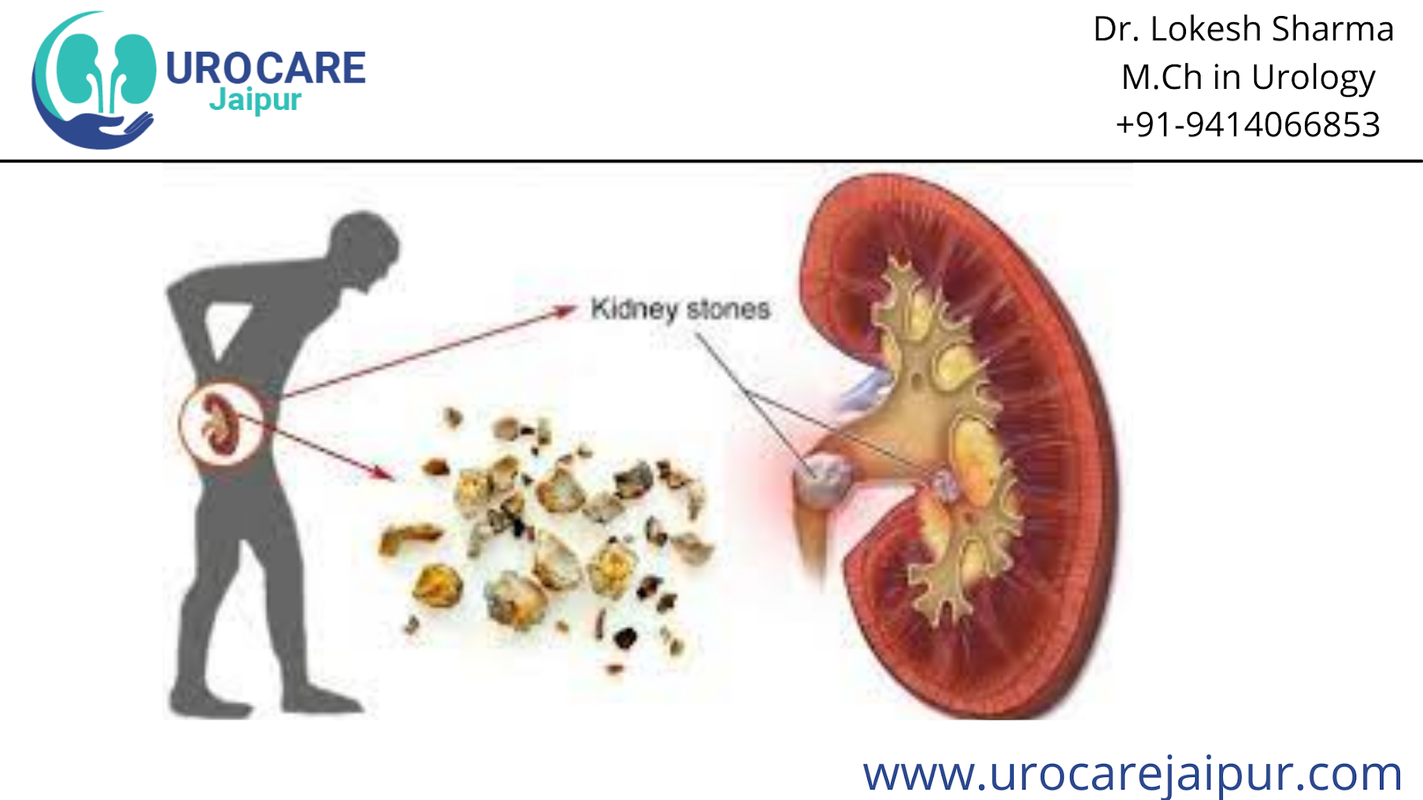 What is the best treatment for kidney stones?