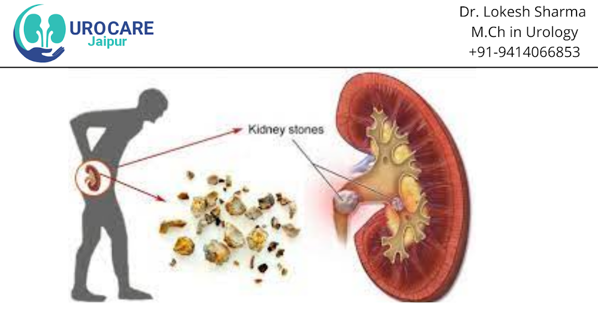 What is the best treatment for kidney stones?