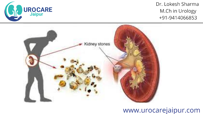 What is the best treatment for kidney stones?
