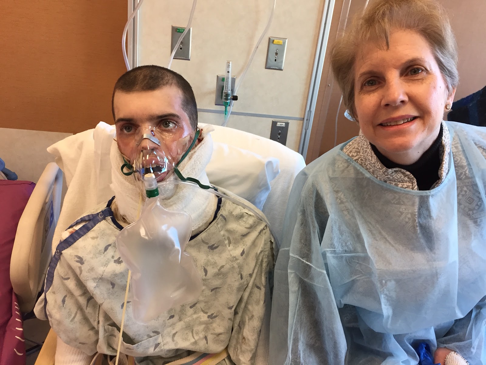 Daniel's Burn: Day 21 - 3 Weeks in ICU Burn