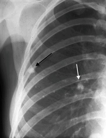 HISTOLOGÍA un enfoque clínico: TUBERCULOSIS
